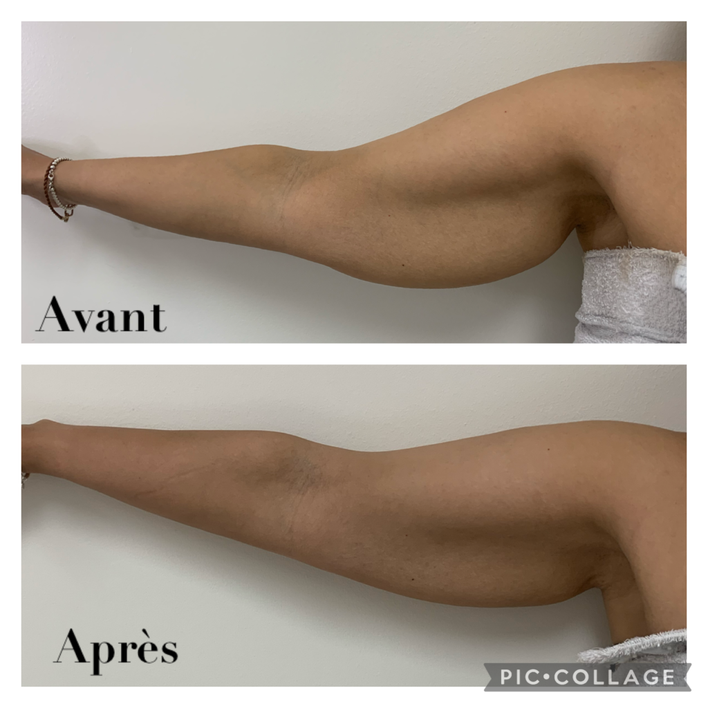 Avant / Après | Novacorps - Medico esthétique Montréal